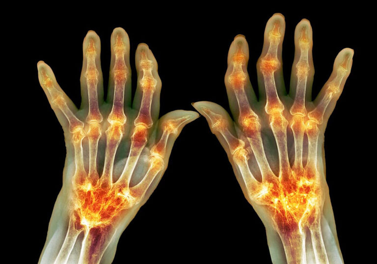 Novel Antibiotic Cement May Help Treat Bone Infections – Impact Lab