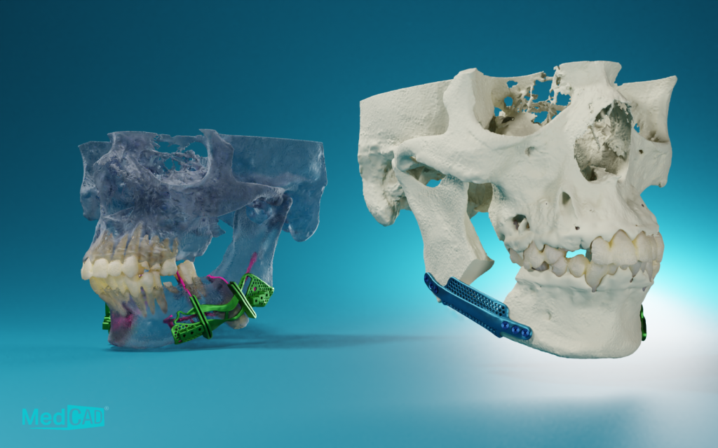 MedCAD Advances Facial Reconstruction with 3D-Printed Titanium Plates ...